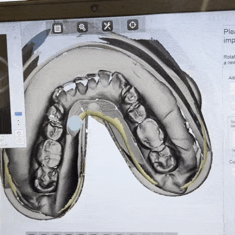 Clear Retainer for Teeth Grinding & Alignment | Remi
